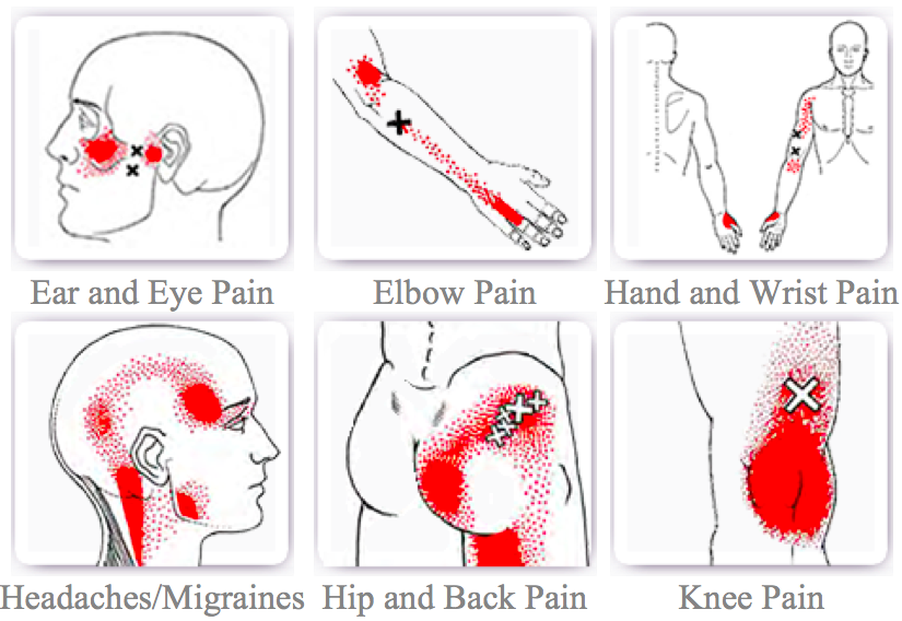 Treatment Methods – Dr HOA PAIN & PHYSIOTHERAPY CLINIC